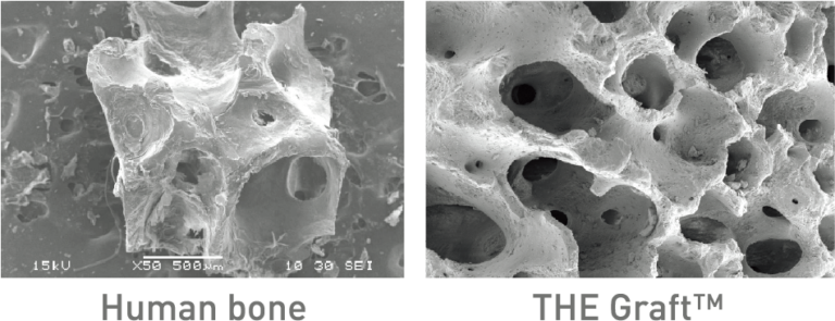 THE Graft™ – Safe and Reliable Xenograft Porcine Bone Substitute ...